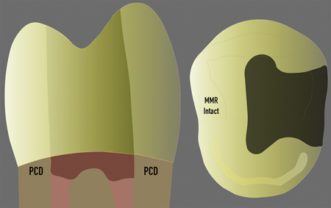 The Endodontic Restorative Harmonic: Part I Access To Apex, Apex To ...