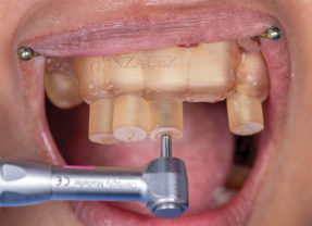 Dynamic Navigation For Orthograde And Retrograde Endodontics