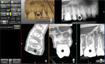 Dynamic Navigation For Orthograde And Retrograde Endodontics