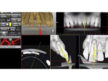 Dynamic Navigation For Orthograde And Retrograde Endodontics