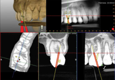 Dynamic Navigation For Orthograde And Retrograde Endodontics