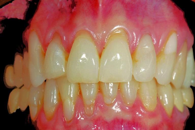 Totally Simplified Colour Matching: Single Shade Direct Composite