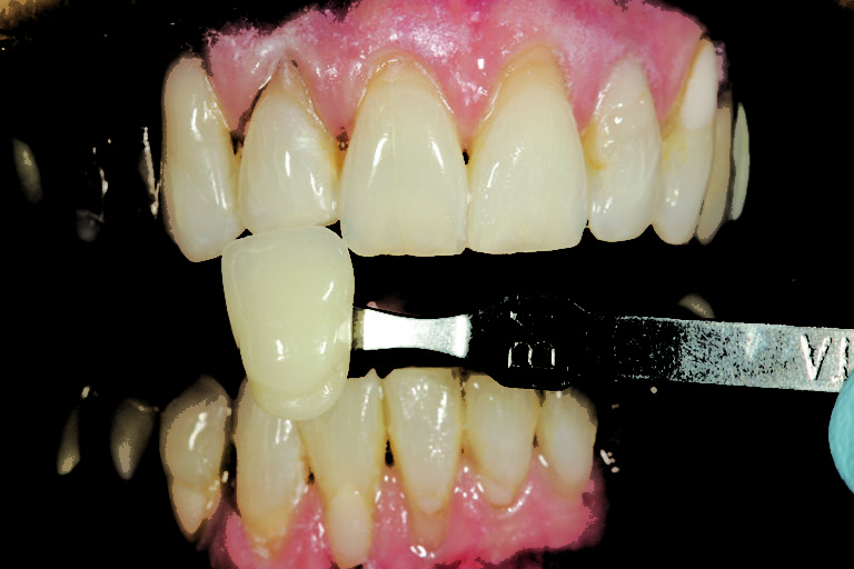 Totally Simplified Colour Matching: Single Shade Direct Composite