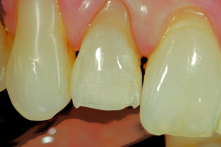 Totally Simplified Colour Matching: Single Shade Direct Composite