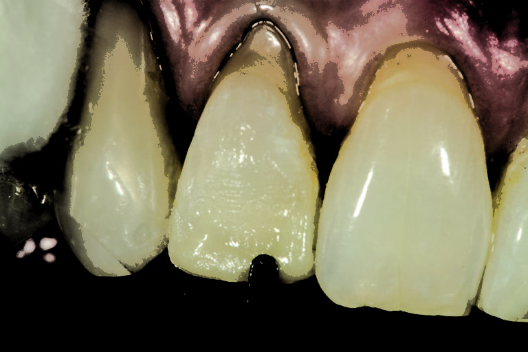 Totally Simplified Colour Matching: Single Shade Direct Composite