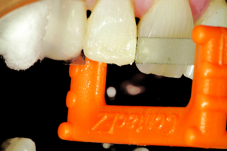 Totally Simplified Colour Matching: Single Shade Direct Composite