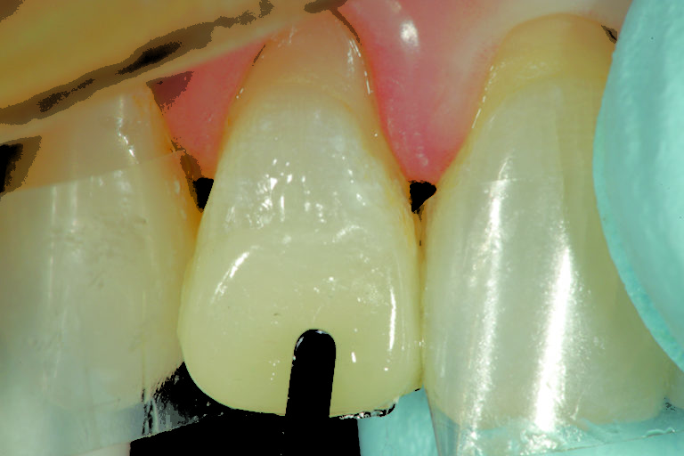 Totally Simplified Colour Matching: Single Shade Direct Composite