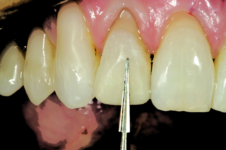Totally Simplified Colour Matching: Single Shade Direct Composite
