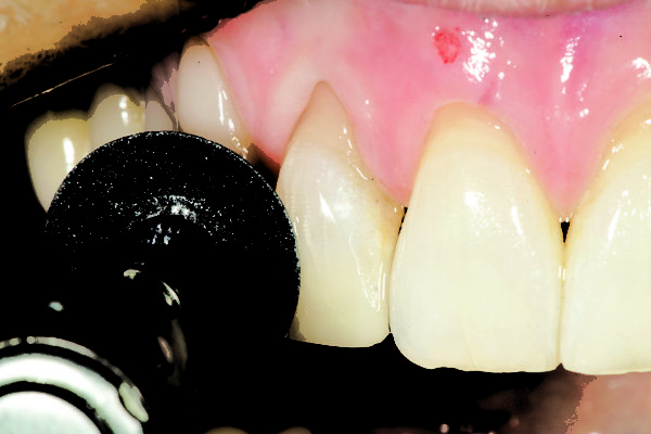 Totally Simplified Colour Matching: Single Shade Direct Composite