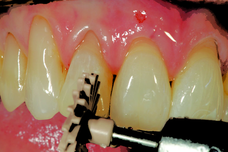 Totally Simplified Colour Matching: Single Shade Direct Composite