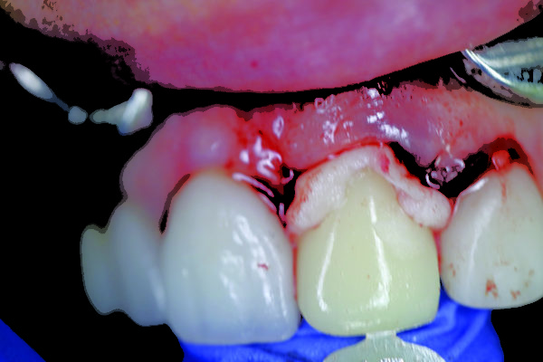 Colour Modifiers To Match An Odd Shade - Oral Health Group
