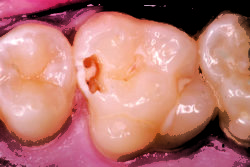 Ward Figure 21 Initial Approach towards interproximal decay - Oral ...