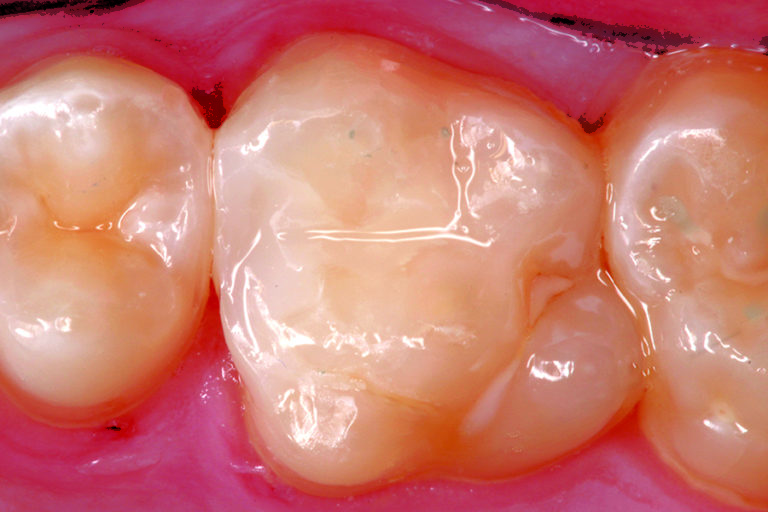 Ward Figure 26 Completed Class II restoration - Oral Health Group