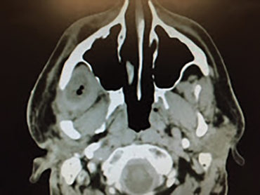 Temporal Space Abscess Misdiagnosed As Temporal Arteritis