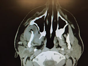 Temporal Space Abscess Misdiagnosed As Temporal Arteritis