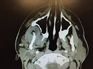 Temporal Space Abscess Misdiagnosed As Temporal Arteritis
