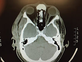 Temporal Space Abscess Misdiagnosed As Temporal Arteritis