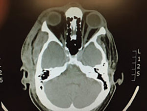 Temporal Space Abscess Misdiagnosed As Temporal Arteritis