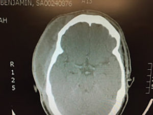 Temporal Space Abscess Misdiagnosed As Temporal Arteritis