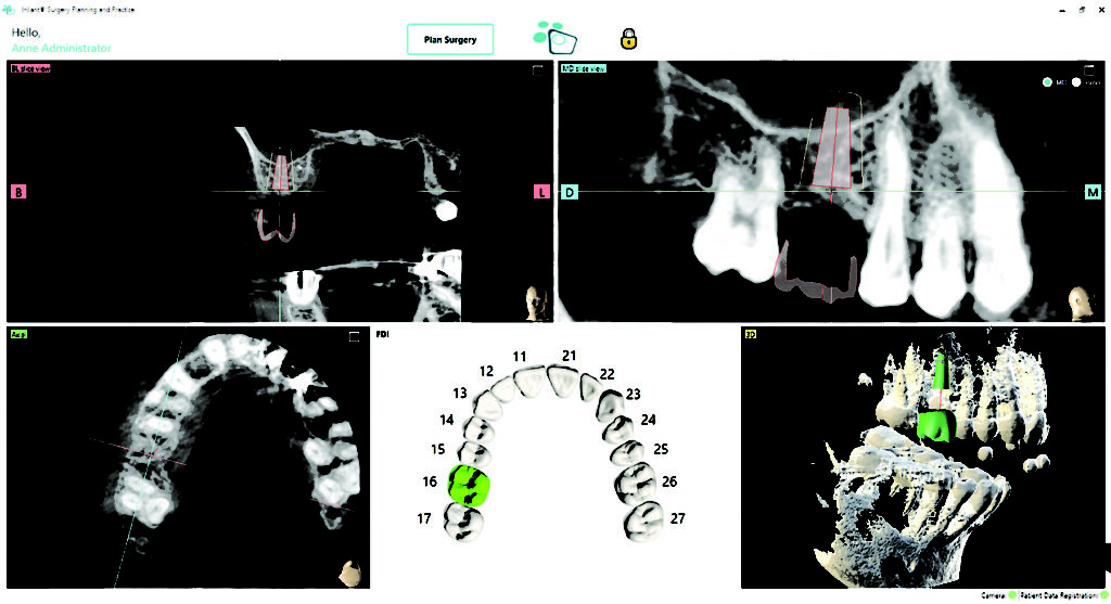Dynamic Navigation: Implant Placement In Close Proximity To Sinus Floor