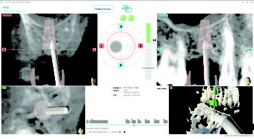 Dynamic Navigation: Implant Placement In Close Proximity To Sinus Floor