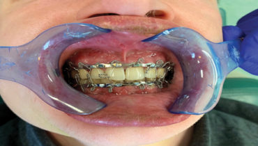Maxillofacial Hardware: A Review Of Techniques - Oral Health Group