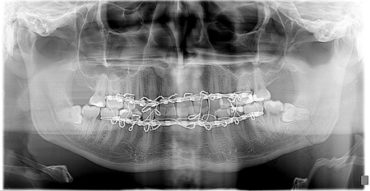 Maxillofacial Hardware: A Review Of Techniques - Oral Health Group