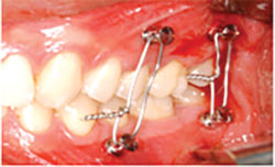 Maxillofacial Hardware: A Review Of Techniques - Oral Health Group