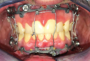 Maxillofacial Hardware: A Review Of Techniques - Oral Health Group