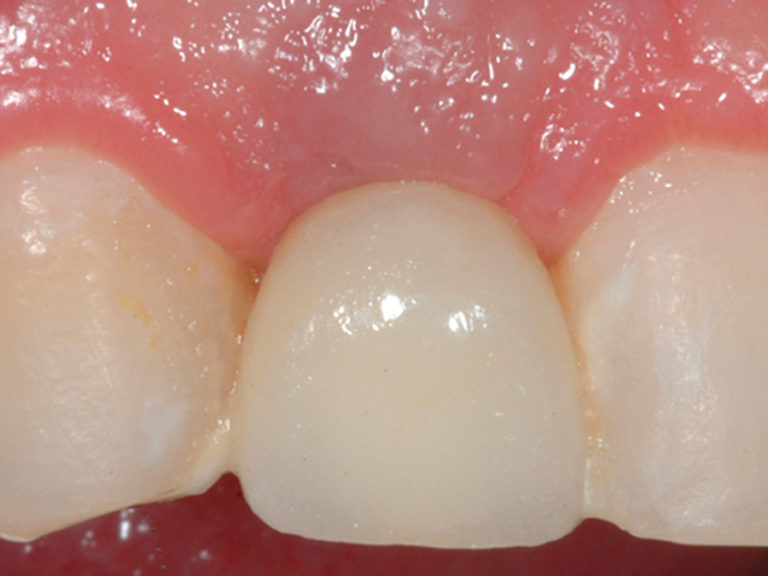 Risk Factors In Implant Dentistry: Unrestorable Implants - Oral Health