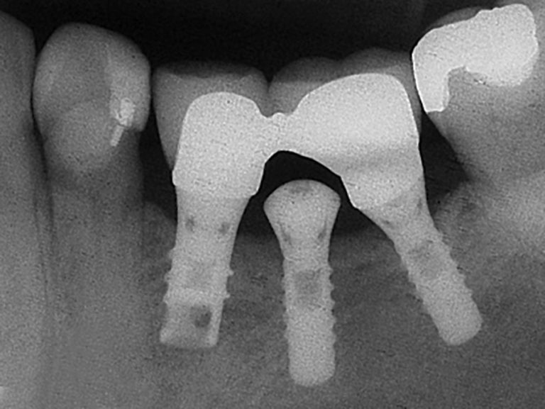Risk Factors In Implant Dentistry: Unrestorable Implants - Oral Health