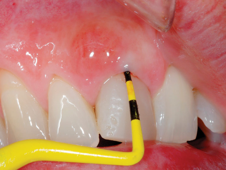 Risk Factors In Implant Dentistry: Unrestorable Implants - Oral Health
