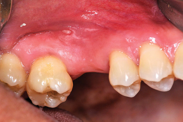 Crestal Sinus Elevation For Implant Placement - Oral Health Group