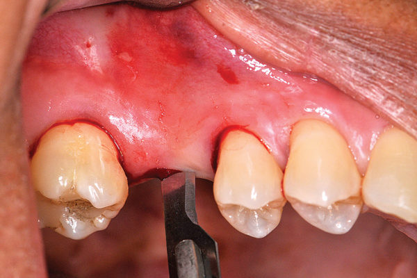 Crestal Sinus Elevation For Implant Placement - Oral Health Group