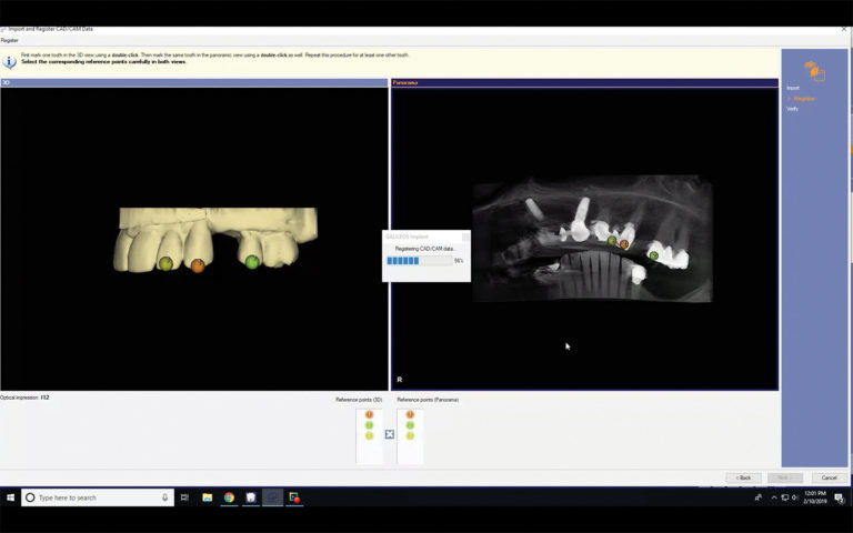 A Digital Workflow For Guided Implant Surgery Using CEREC Guide 2