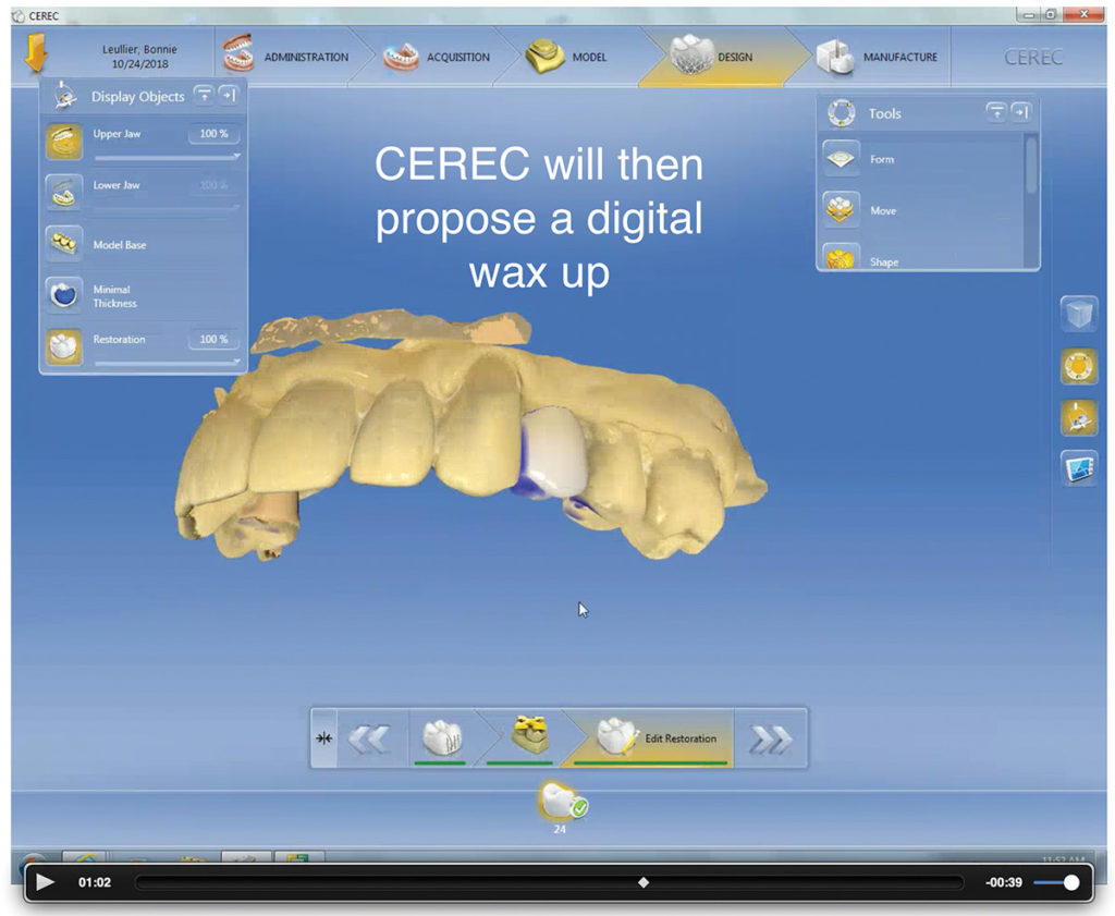 A Digital Workflow For Guided Implant Surgery Using CEREC Guide 2