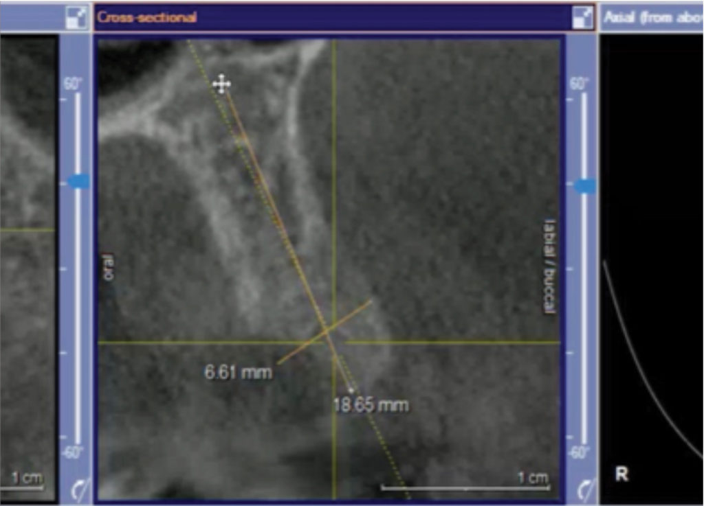 A Digital Workflow For Guided Implant Surgery Using CEREC Guide 2