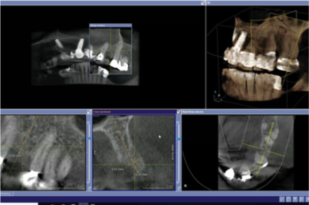 A Digital Workflow For Guided Implant Surgery Using CEREC Guide 2