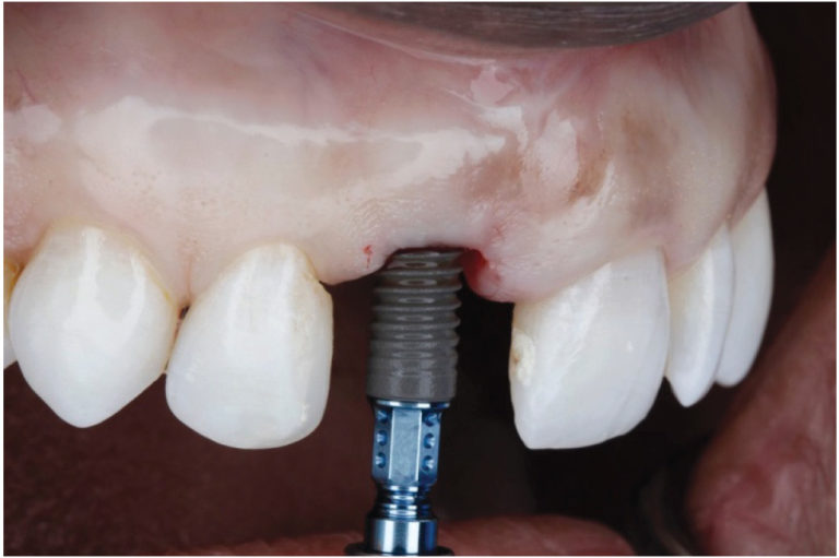 Minimally Invasive Management Of A Failed Implant - Oral Health Group
