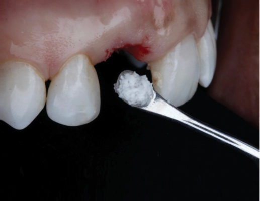 Minimally Invasive Management Of A Failed Implant - Oral Health Group