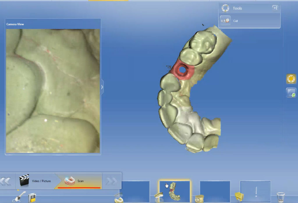 A Digital Workflow For Guided Implant Surgery Using CEREC Guide 2