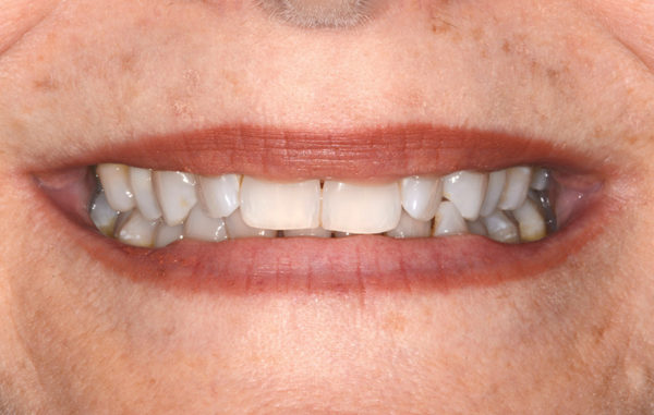 Treating The Black Triange With The Bioclear Method - Oral Health Group