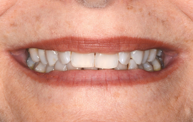 Treating The Black Triange With The Bioclear Method - Oral Health Group