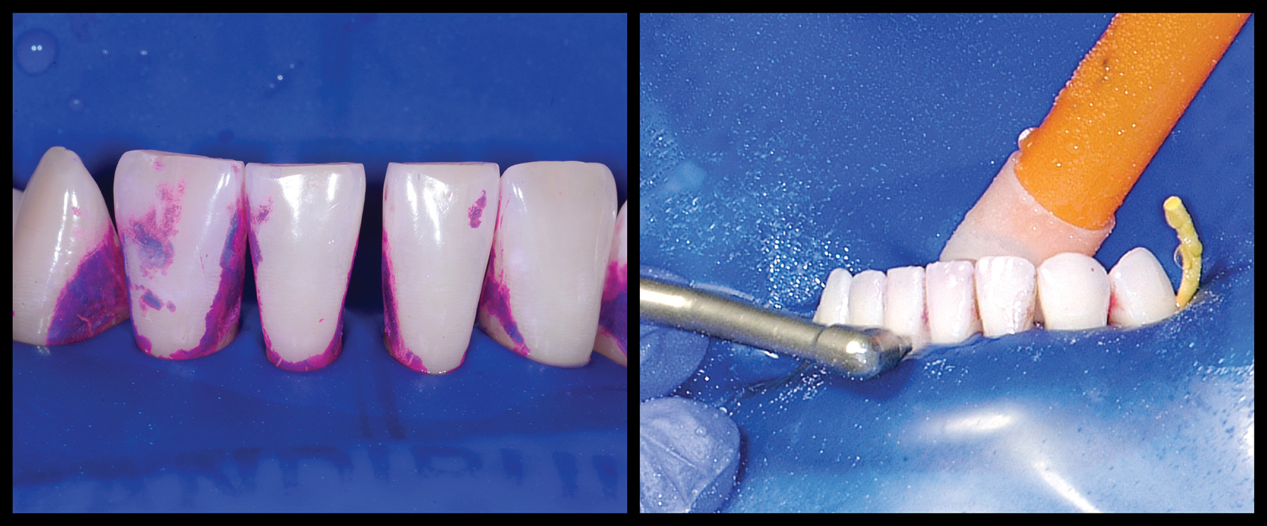用生物透明法治疗黑三角——口腔健康组