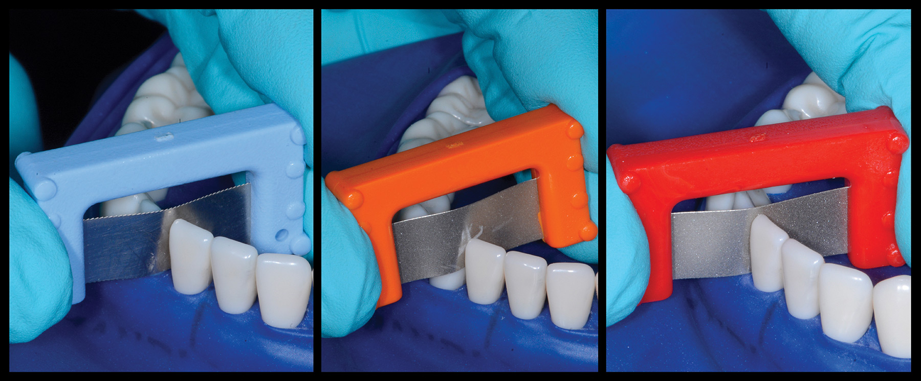 Treating The Black Triange With The Bioclear Method - Oral Health Group