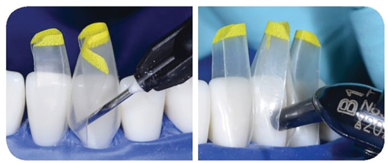 Treating The Black Triange With The Bioclear Method - Oral Health Group