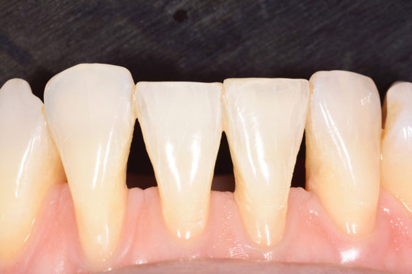 Treating The Black Triange With The Bioclear Method - Oral Health Group