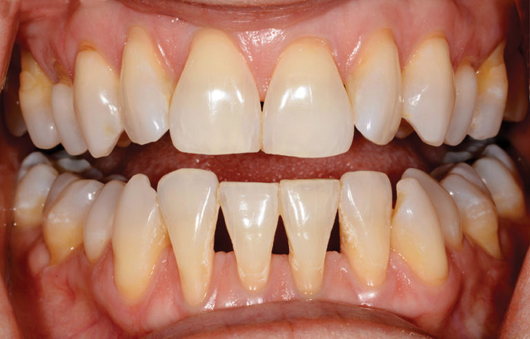 Treating The Black Triange With The Bioclear Method - Oral Health Group