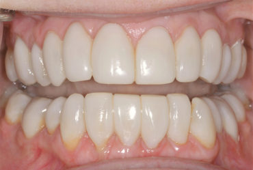 Treating The Black Triange With The Bioclear Method - Oral Health Group
