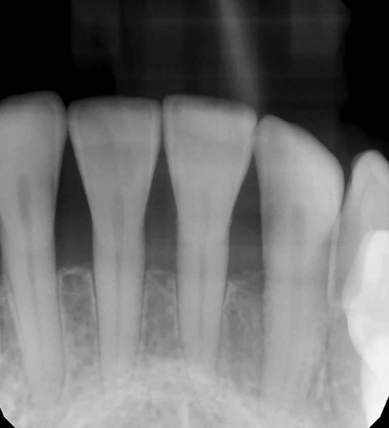 Treating The Black Triange With The Bioclear Method - Oral Health Group